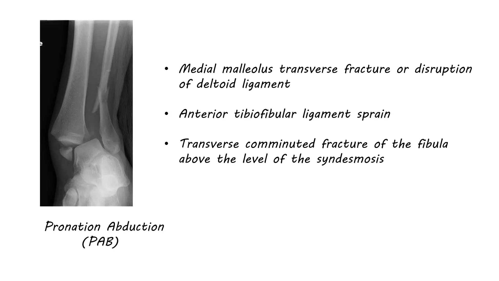 Bony-ankle-injuries.pptx