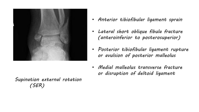 Bony-ankle-injuries.pptx