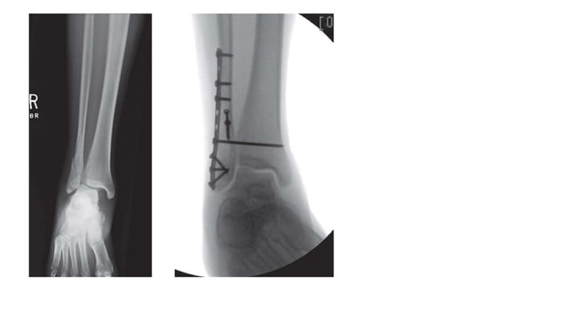 Bony-ankle-injuries.pptx