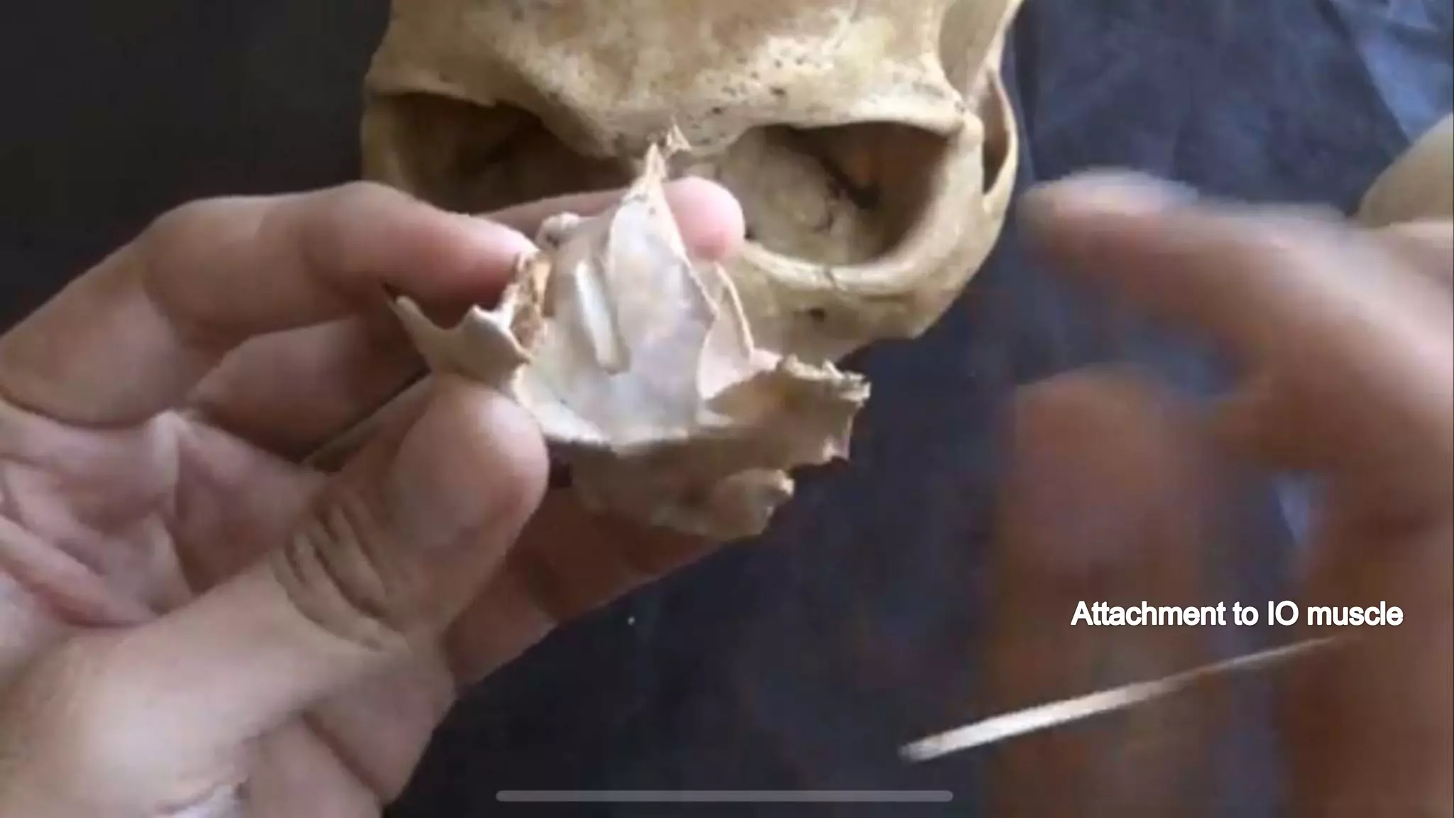 Anatomy of the Bony orbit | PPTX