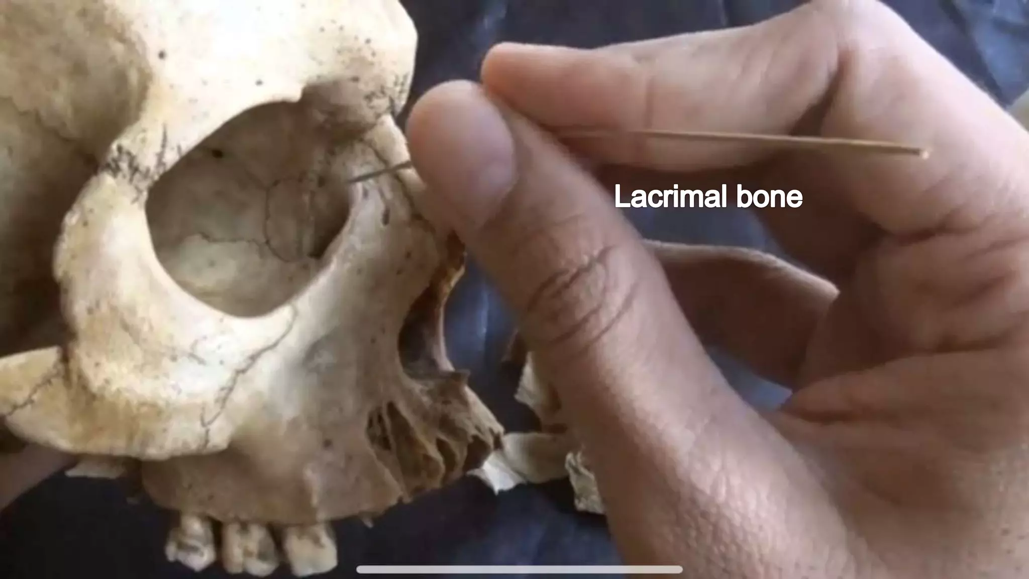 Anatomy of the Bony orbit | PPTX