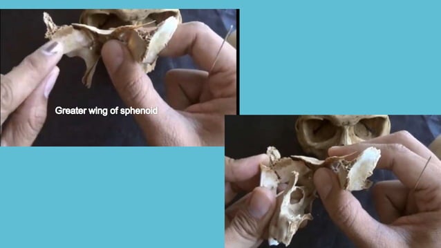 Anatomy of the Bony orbit | PPTX