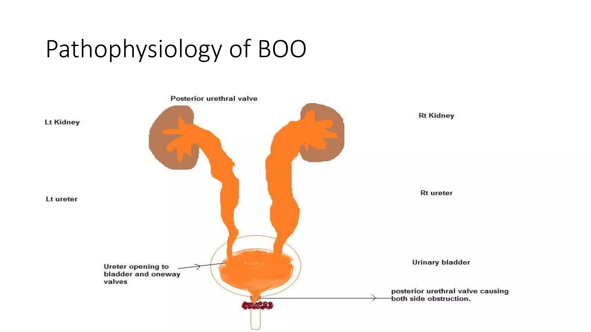 Bladder outlet obstruction in children | PPTX