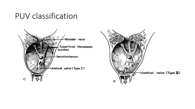 Bladder outlet obstruction in children | PPT