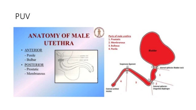 Bladder outlet obstruction in children