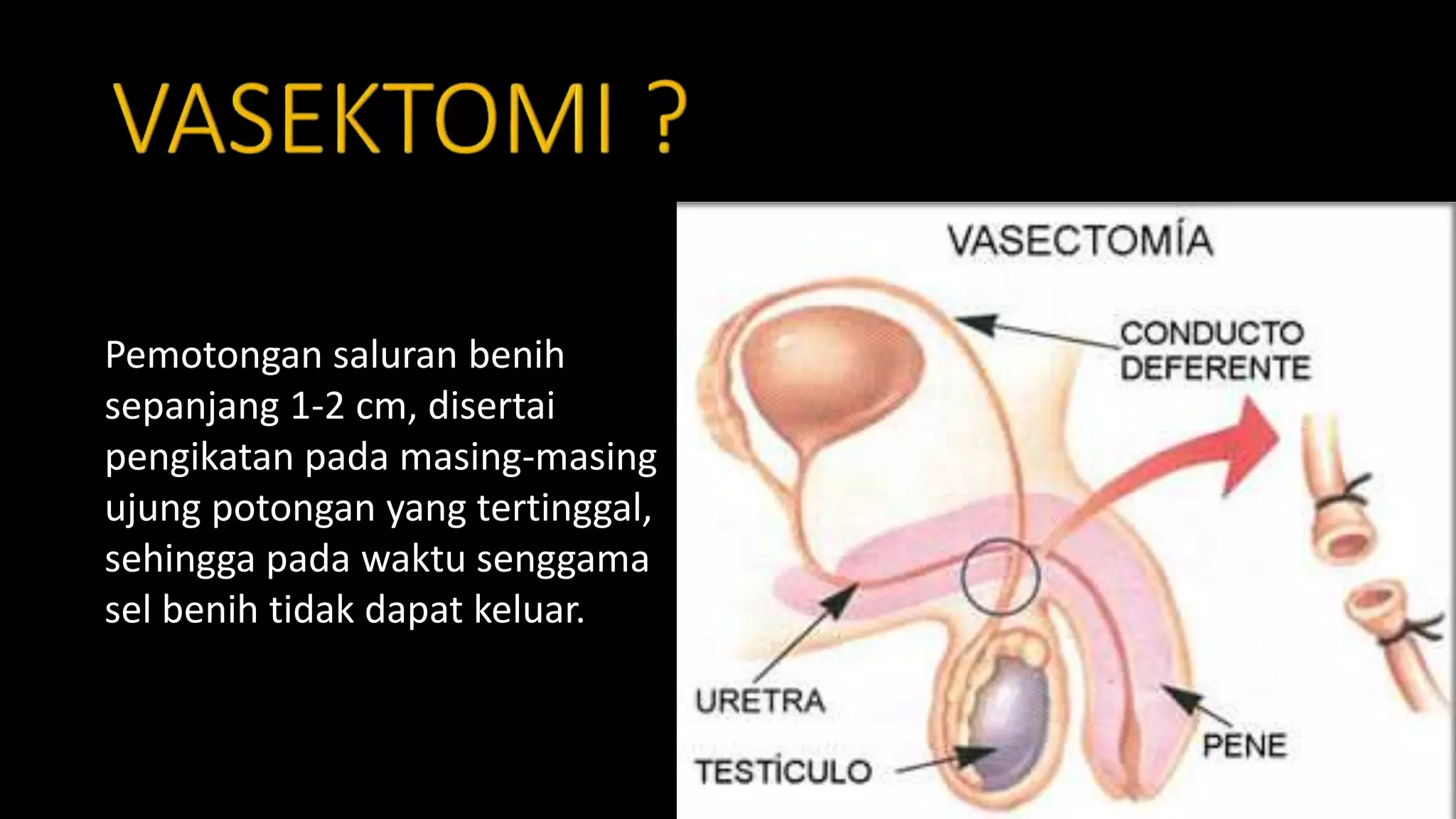 Booklet vasektomi | PPTX