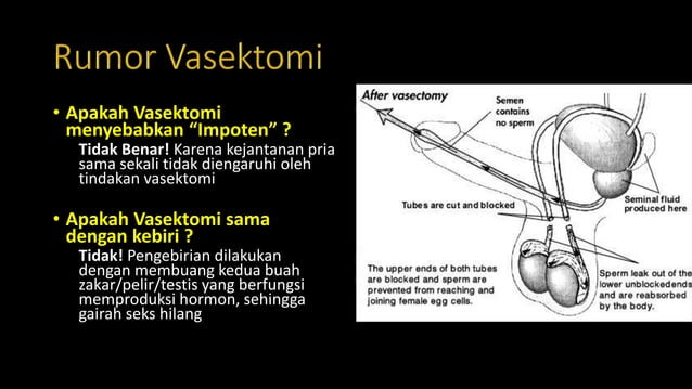 Booklet vasektomi | PPTX