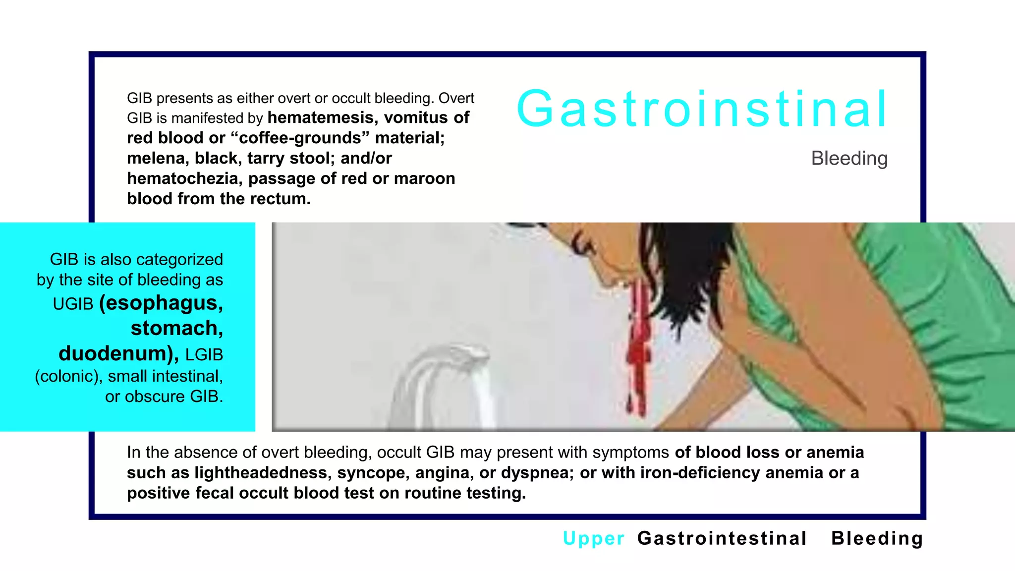 UPPER GI BLEEDING | PPTX