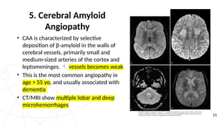 Book Rev Intracerebral Hemorrhage.pptx... | PPT