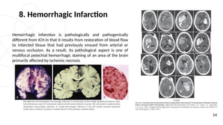 Book Rev Intracerebral Hemorrhage.pptx... | PPT
