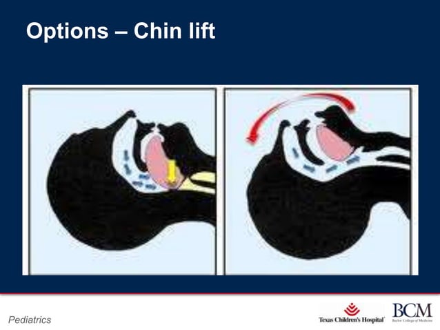 2013 Pediatric Fellows Boot Camp_Adjuncts BMV & LMA | PPT