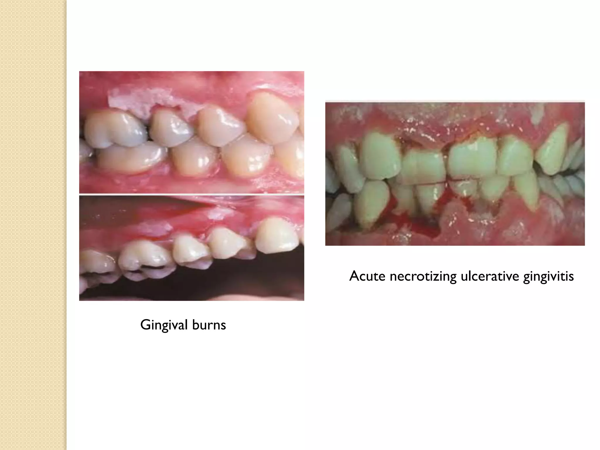 BLEEDING ON PROBING - PERIODONTICS | PPTX