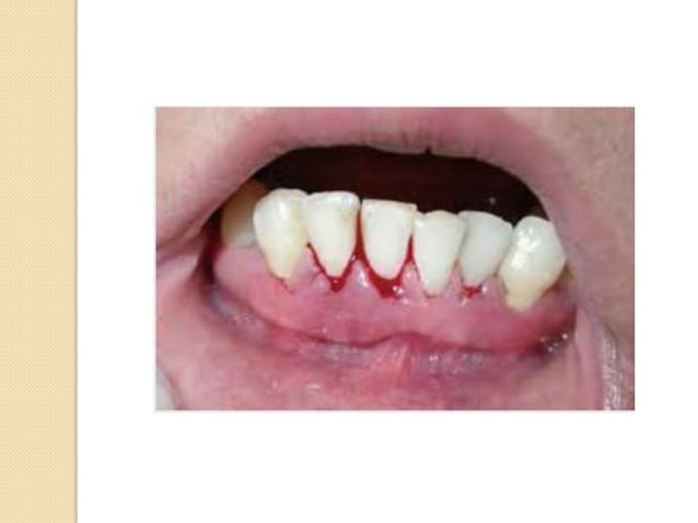 BLEEDING ON PROBING - PERIODONTICS | PPTX