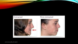 Borderline extraction cases | PPT