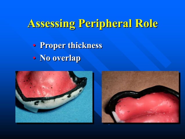Border Molding.ppt | Dental Health | Diseases and Conditions