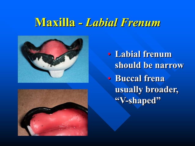 Border Molding.ppt | Dental Health | Diseases and Conditions