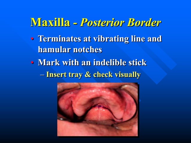 Border Molding.ppt | Dental Health | Diseases and Conditions