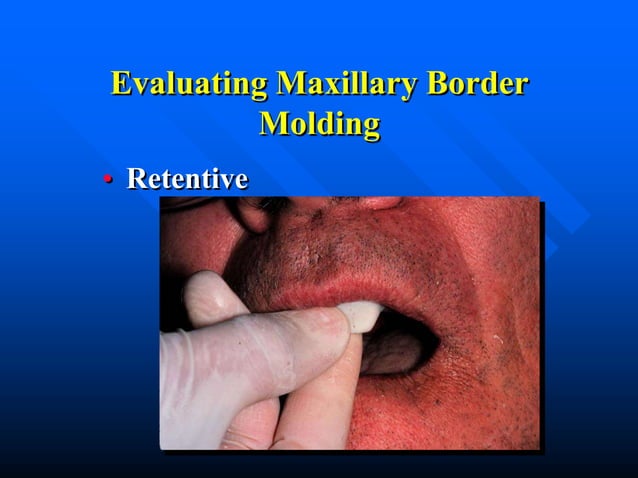 Border Molding.ppt | Dental Health | Diseases and Conditions