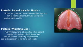 Border Moulding in Complete Denture Prosthesis | PPTX