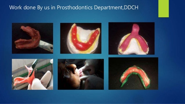 Border Moulding in Complete Denture Prosthesis