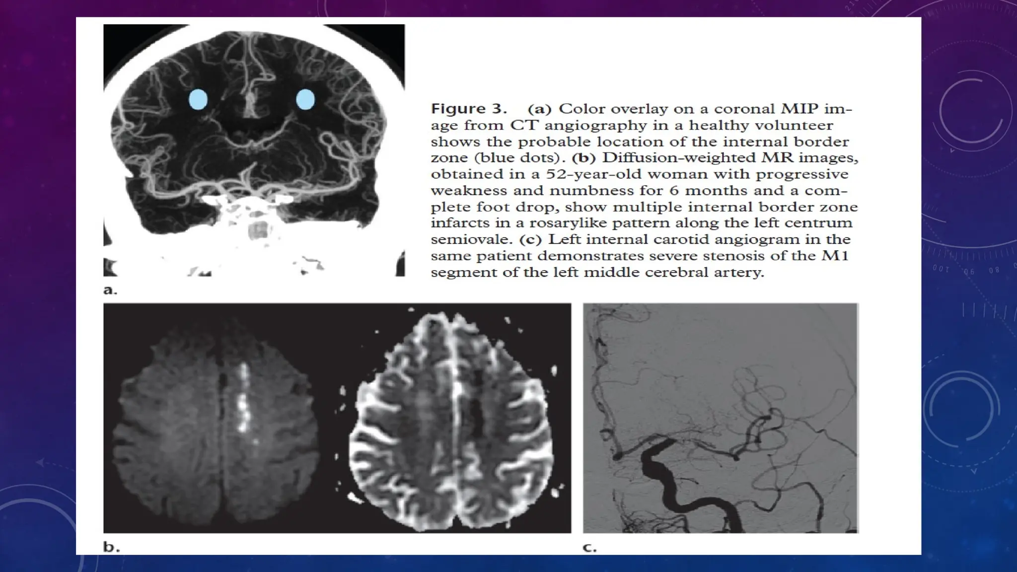 Border zone infarcts in cerebrum and cerebellum.pptx