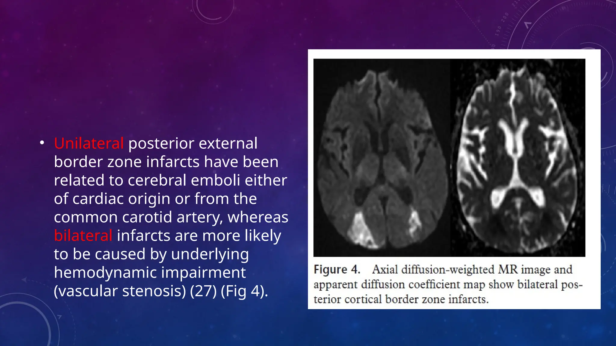 Border zone infarcts in cerebrum and cerebellum.pptx