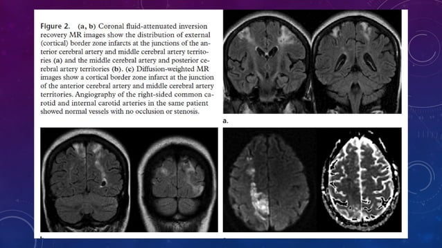 Border zone infarcts in cerebrum and cerebellum.pptx