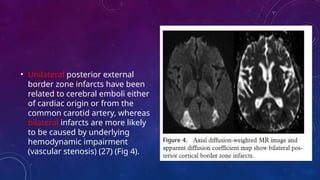 Border zone infarcts in cerebrum and cerebellum.pptx