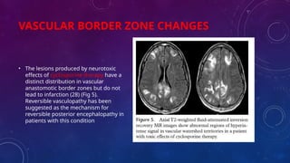 Border zone infarcts in cerebrum and cerebellum.pptx