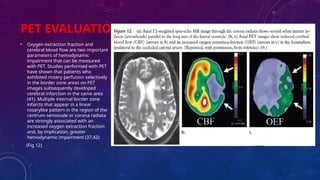 Border zone infarcts in cerebrum and cerebellum.pptx