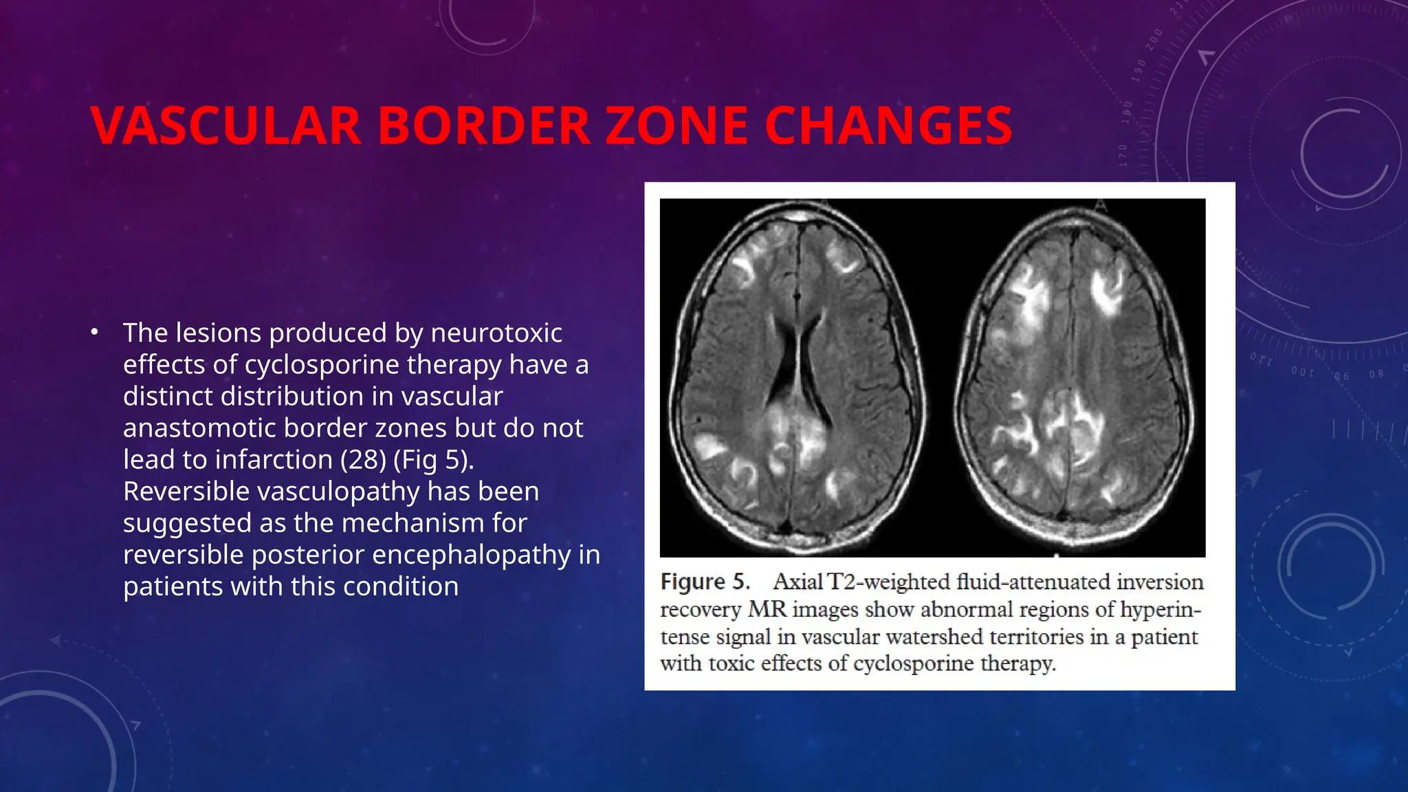 Border zone infarcts in cerebrum and cerebellum .pptx