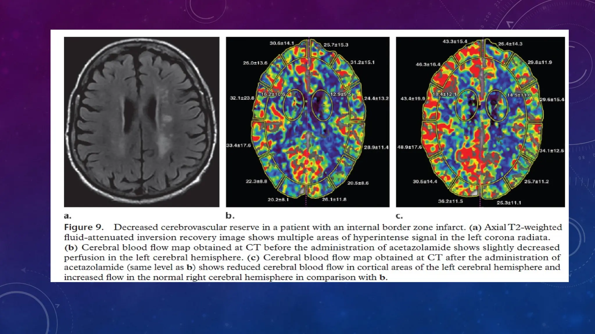 Border zone infarcts in cerebrum and cerebellum .pptx