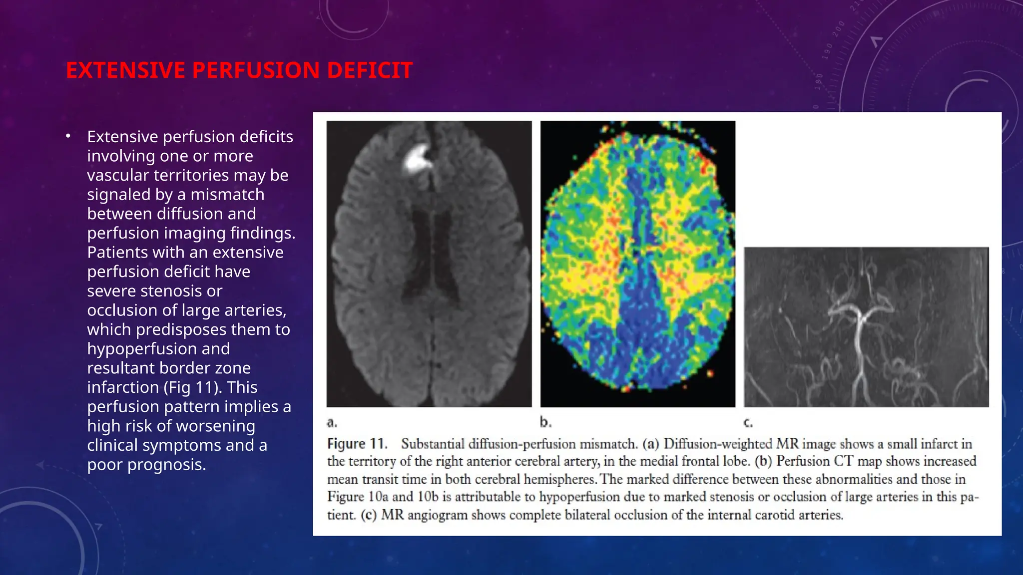 Border zone infarcts in cerebrum and cerebellum .pptx