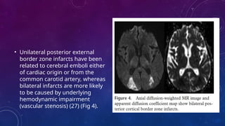 Border zone infarcts in cerebrum and cerebellum .pptx