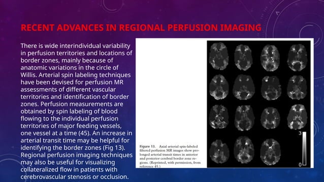 Border zone infarcts in cerebrum and cerebellum .pptx