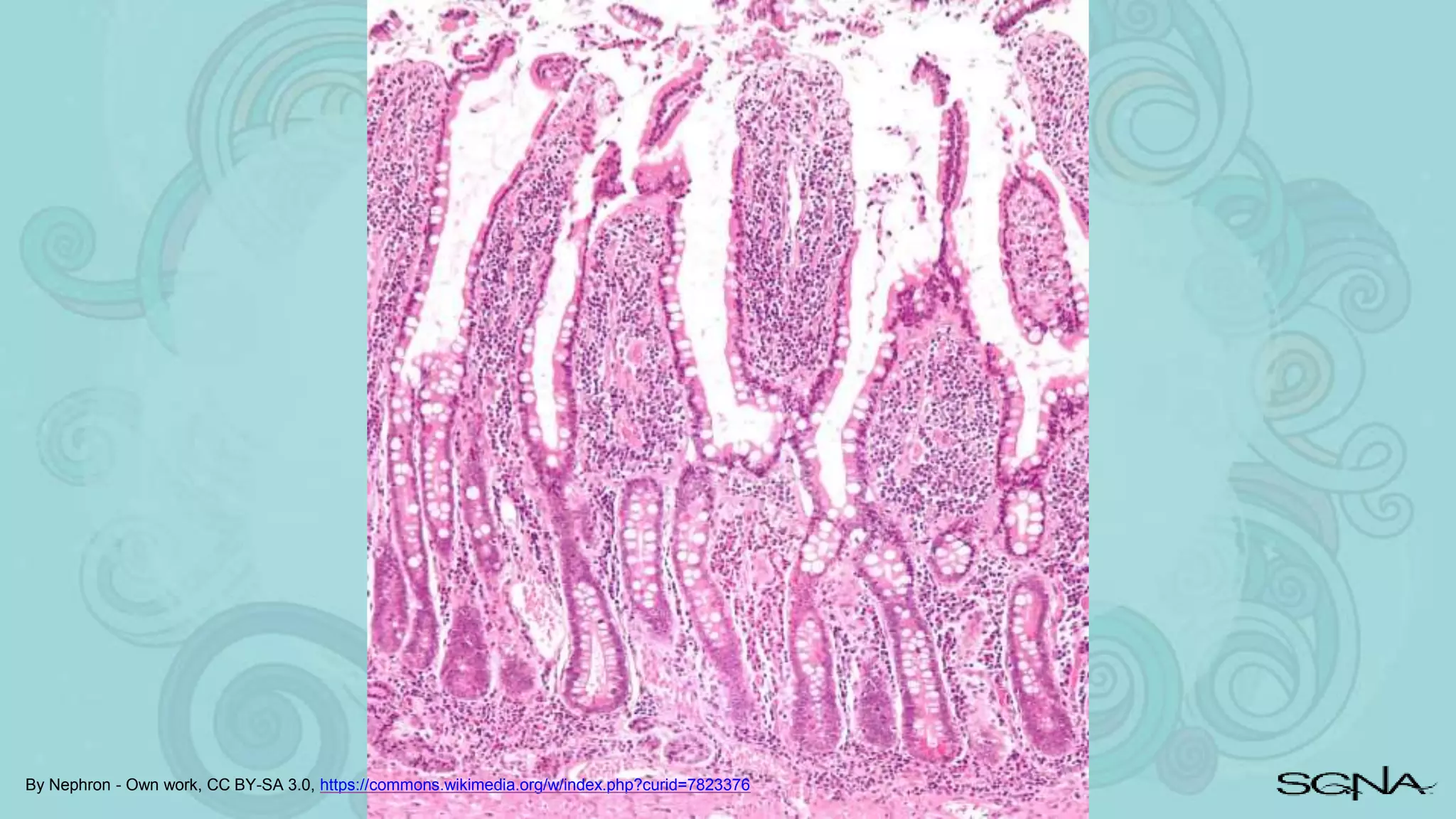 Bored with Barretts: Diagnosing Gastric Intestinal Metaplasia, Meckels ...