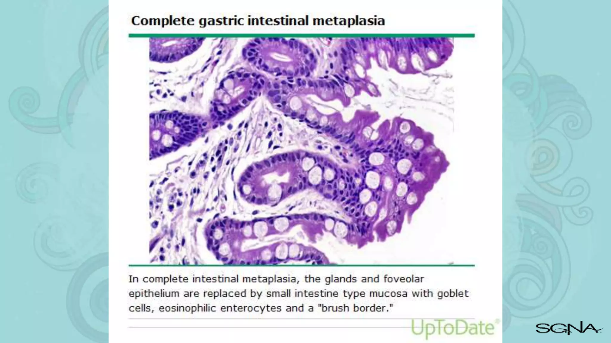 Bored with Barretts: Diagnosing Gastric Intestinal Metaplasia, Meckels ...