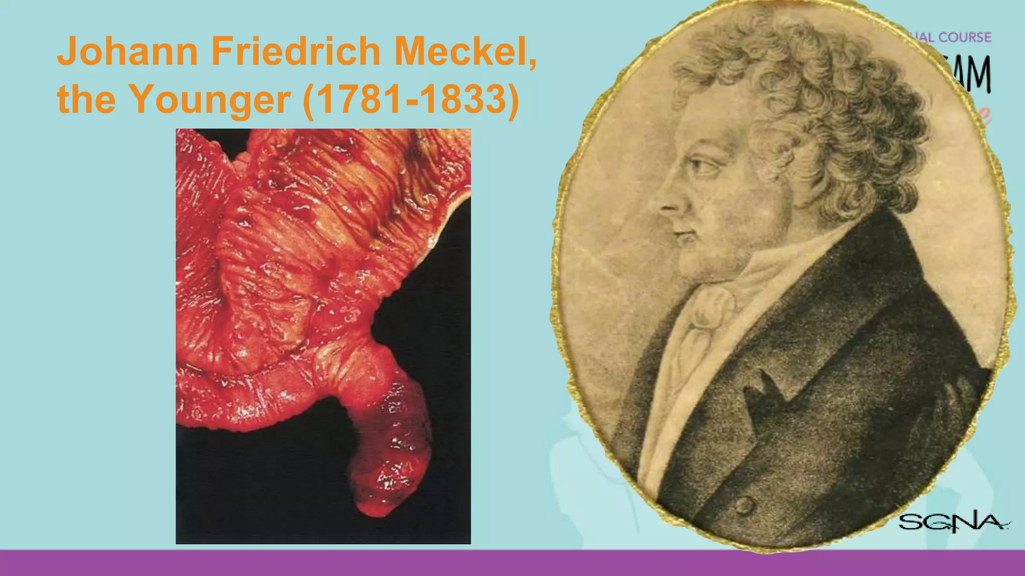 Bored with Barretts: Diagnosing Gastric Intestinal Metaplasia, Meckels ...