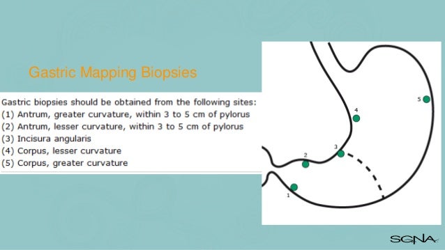 Bored with Barretts: Diagnosing Gastric Intestinal Metaplasia, Meckel…