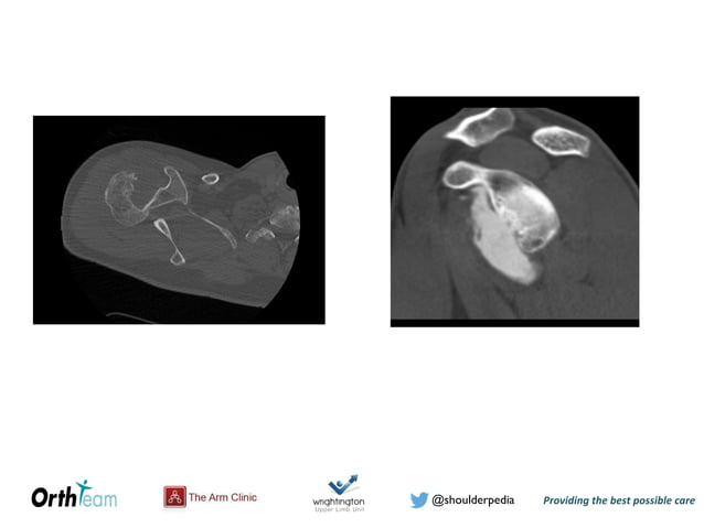 Atraumatic Shoulder Instability Principles and Assessment | PPT