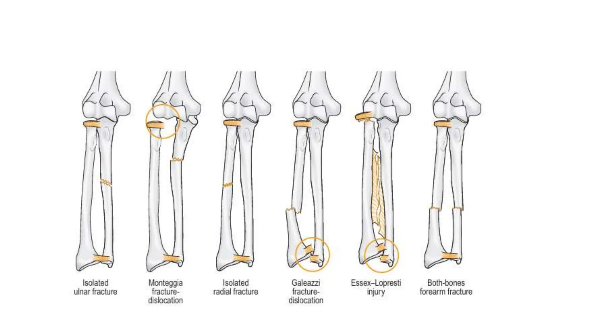 both bone fractures of forearm Monteggia & Galeazzi.pptx