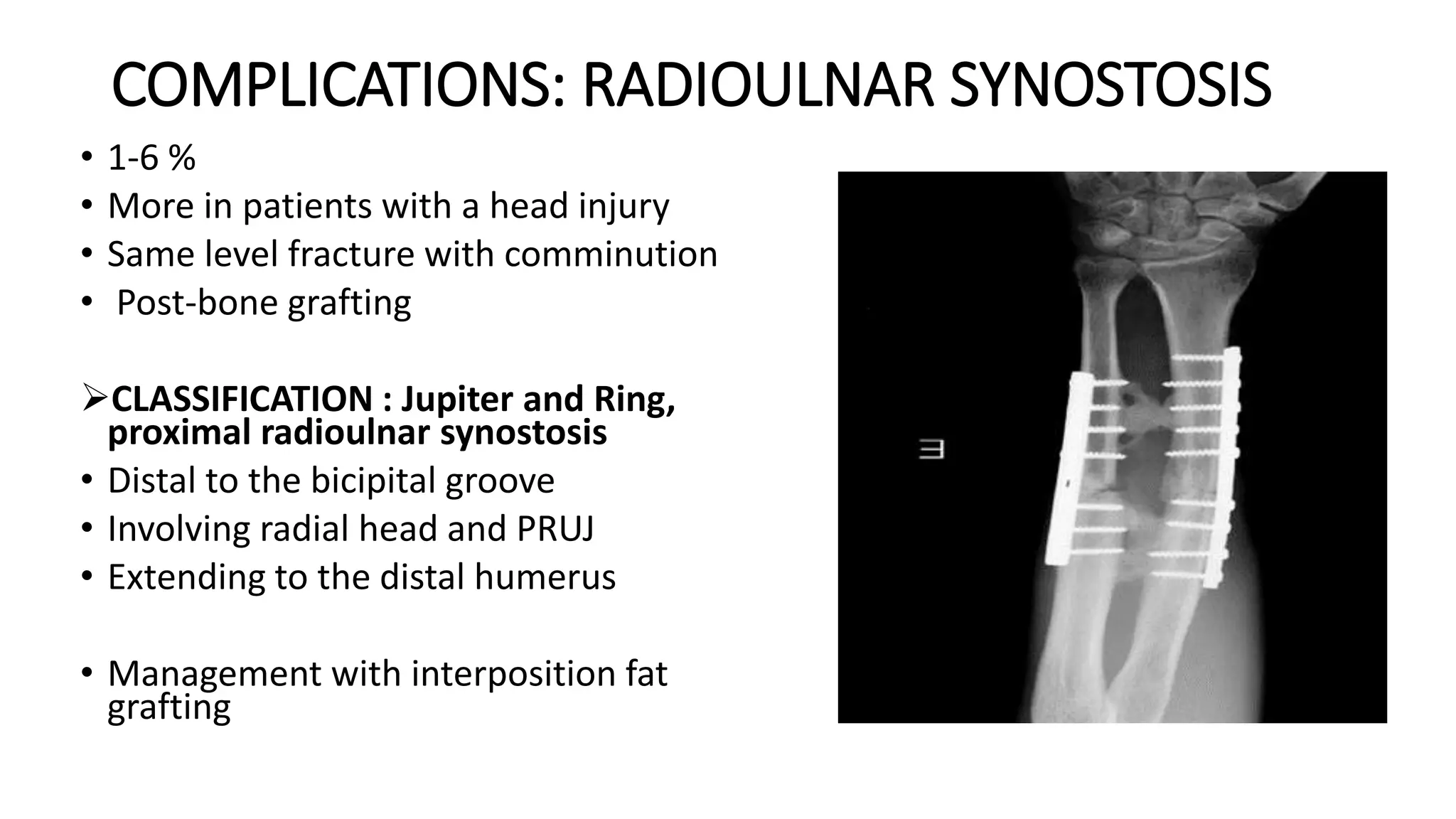 both bone fractures of forearm Monteggia & Galeazzi.pptx