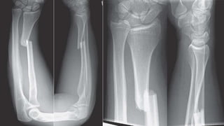 both bone fractures of forearm Monteggia & Galeazzi.pptx