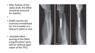 both bone fractures of forearm Monteggia & Galeazzi.pptx