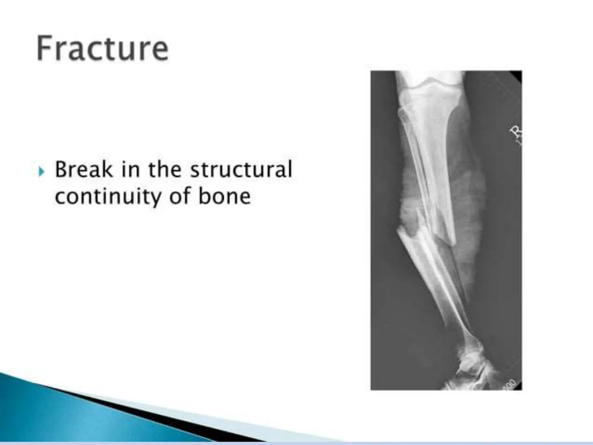 BOTH BONE LEG.ORTHOPEDICS,POWERPOINTpptx | PPTX