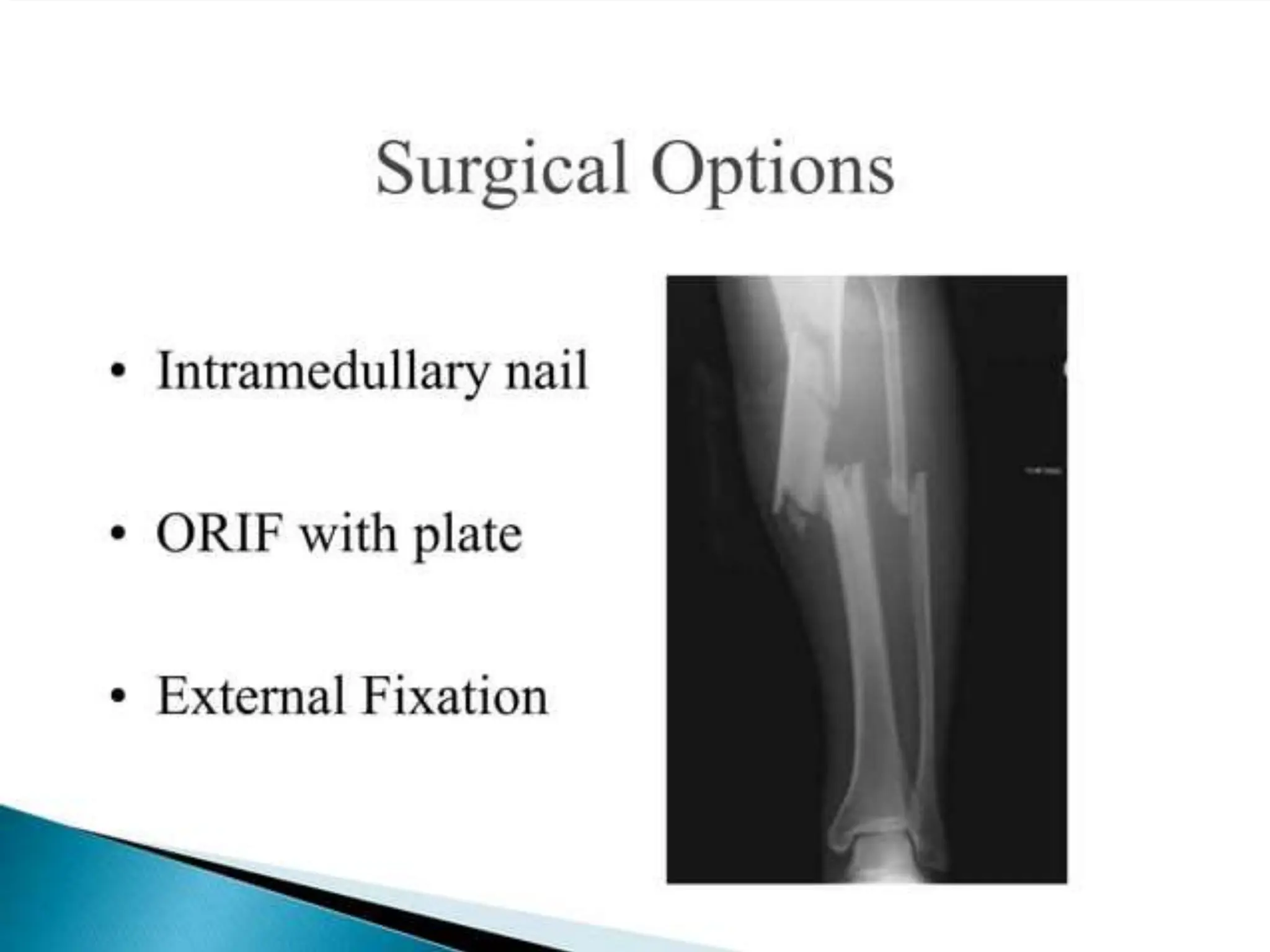 BOTH BONE LEG.ORTHOPEDICS,POWERPOINTpptx | PPTX