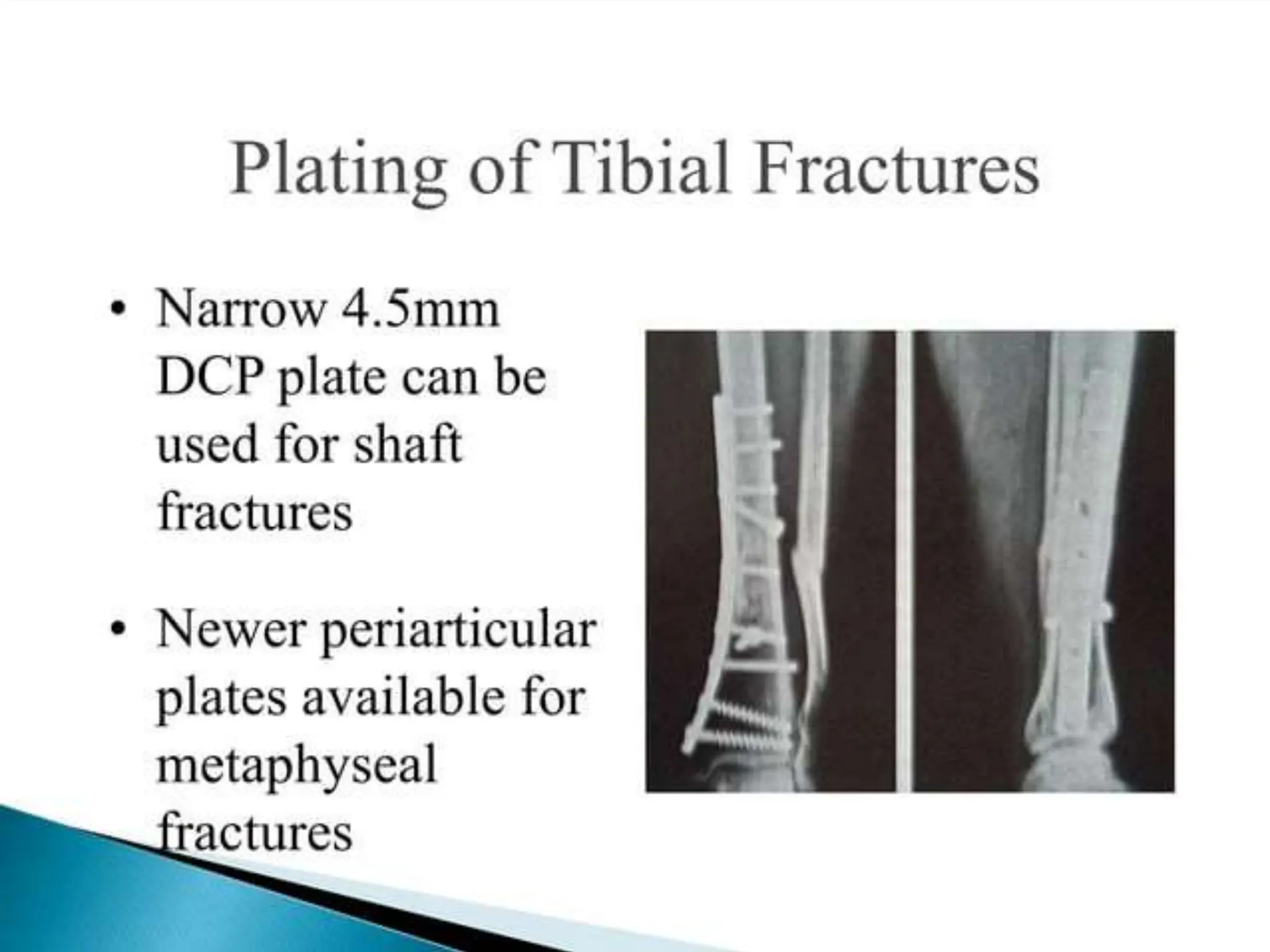 BOTH BONE LEG.ORTHOPEDICS,POWERPOINTpptx | PPTX