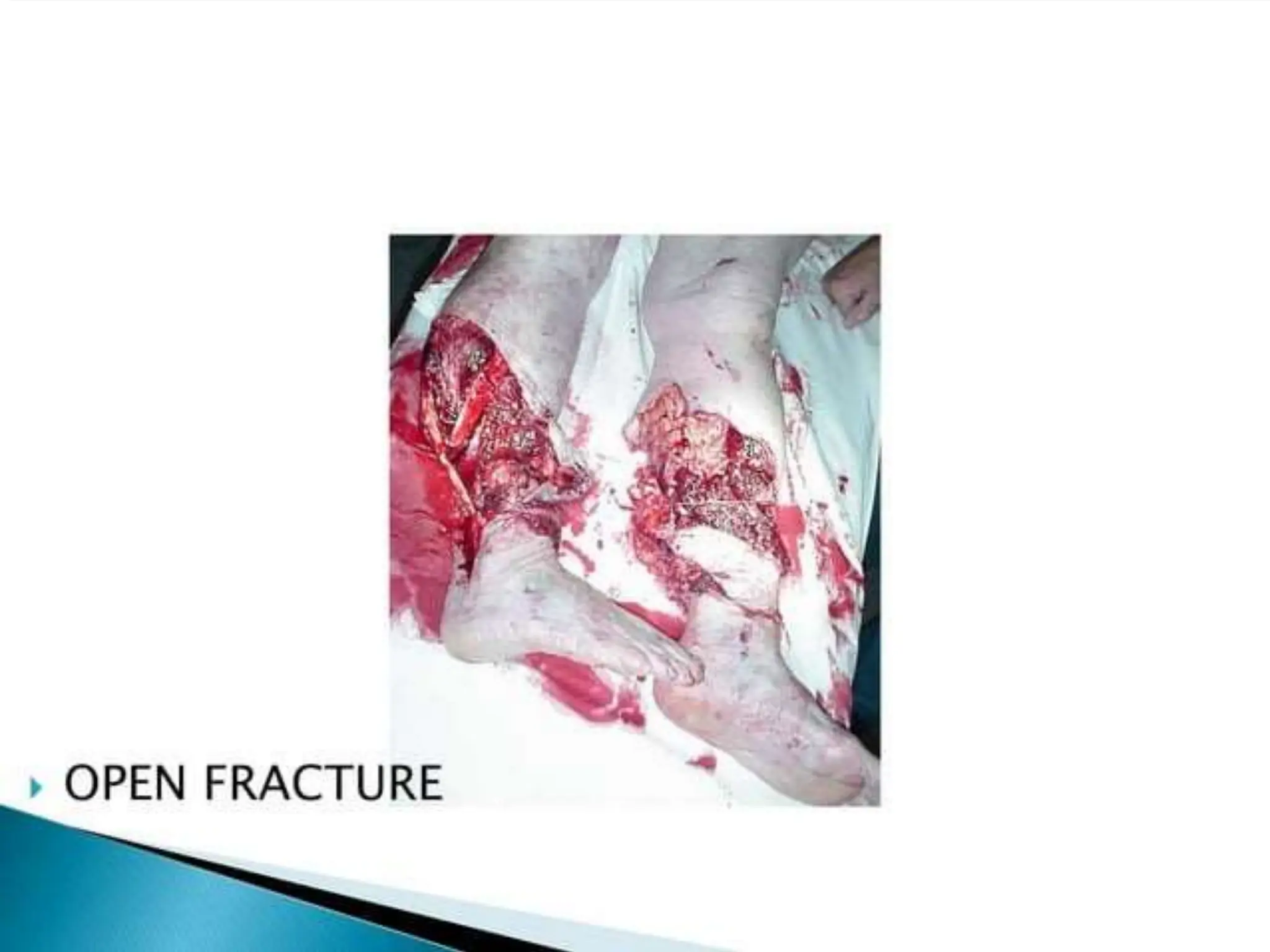 BOTH BONE LEG.ORTHOPEDICS,POWERPOINTpptx | PPTX