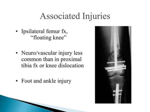 BOTH BONE LEG.ORTHOPEDICS,POWERPOINTpptx | PPT