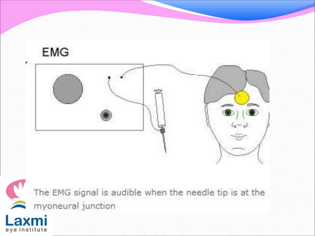 Botox in Ophthalmology | PPTX | Eye and Vision Conditions | Diseases ...